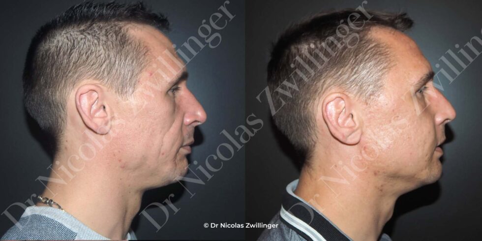 Le Meilleur Lipofilling Visage à Paris : Rajeunir Le Visage Naturellement